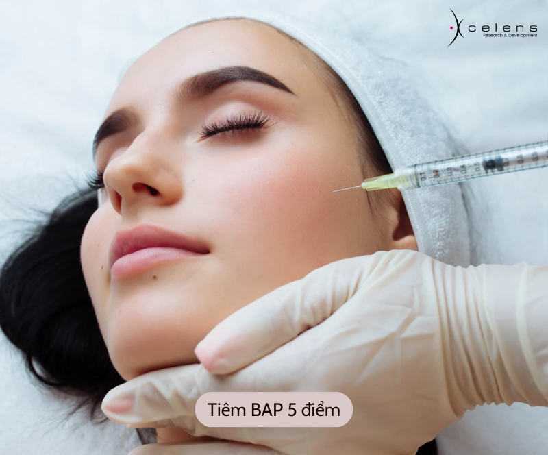 Những điều cần biết về phương pháp tiêm BAP trong thẩm mỹ - Cung cấp ...