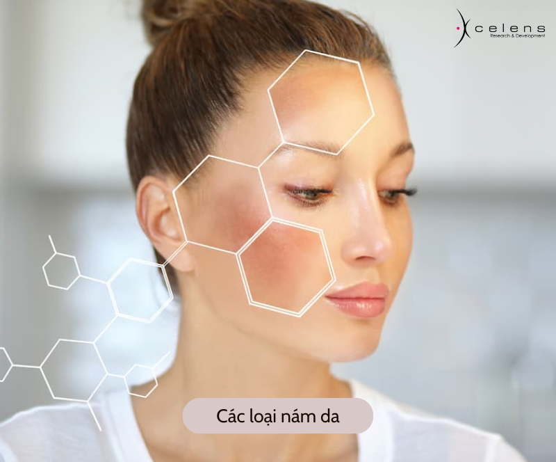 Top 7 cách trị nám tàn nhang hữu hiệu nhất hiện nay - Dr SkinCare - Tư ...