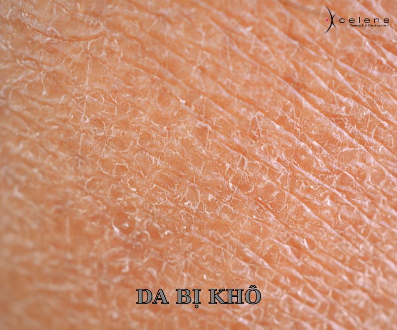 Nguyên nhân da bị khô là gì? Có nên điều trị bằng meso? - Dr SkinCare ...